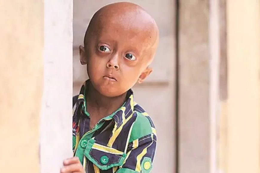 A man suffering from 'progeria' died at the age of 28, the young man ...